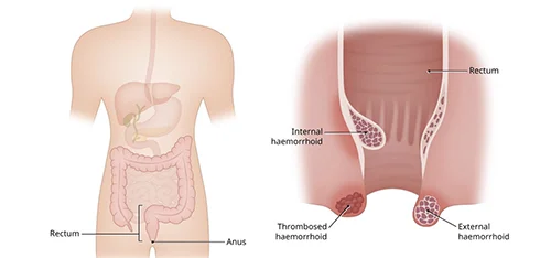Haemorrhoids Piles Symptoms Prevention And Treatment Options